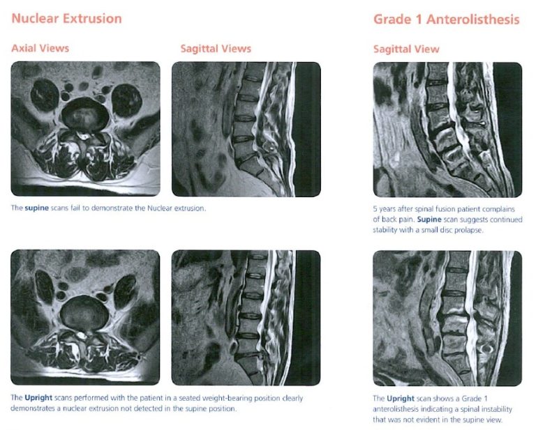 Back Pain - "All In The Mind"? 'Upright' MRI vs 'Supine' MRI Insights ...